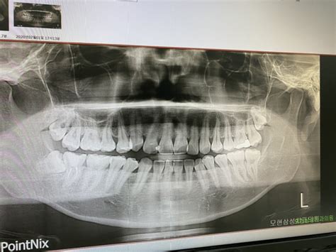 익산 모현삼성치과에서 매복 사랑니 발치 윗니아랫니 다 발치 크라운 레진 치료 후기 네이버 블로그