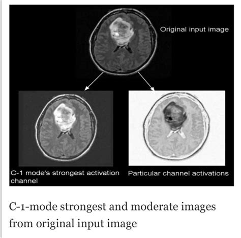 Deep Learning Based Multi Classification System For Brain Malignancies