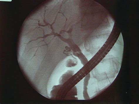 Endoscopic Retrograde Cholangiopancreatography Abdominal Key