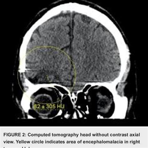 Computed Tomography Head Without Contrast Coronal View Yellow Circle