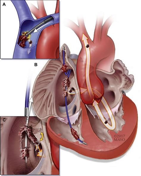 A Transvenous Lead Removal May Lead To Dislodgment Of Endocardial Lead