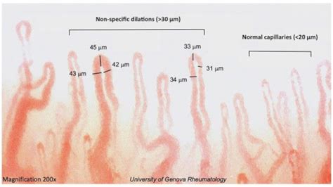 Understanding The Value Of Non Specific Abnormal Capillary Dilations In Presence Of Raynauds