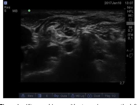 Figure 1 From Supraclavicular Nerve And Superior Trunk Block For Surgical Treatment Of Clavicle