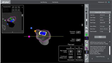 Retroversion Of 24 Achievable With Stem 37 5 No 0 L 125 Mm Download