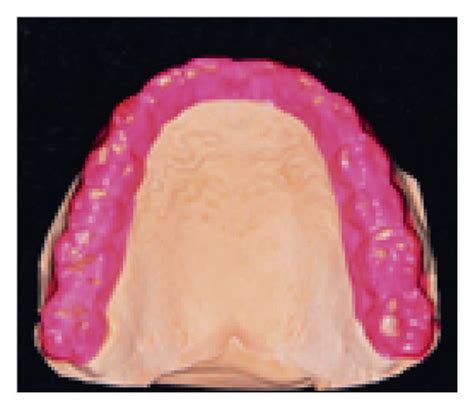 Brux Checker Findings A Before Orthodontic Treatment B Just Download Scientific Diagram