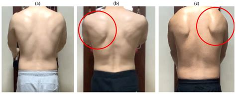 Scapular Dyskinesis Pas Scapular Dysfunction Best Performance Group