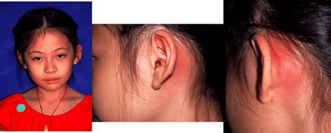 Acute Otitis Media Aom Hyperexcision