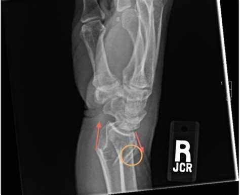 Distal Radius Fracture With Dorsal Angulation Published In Orthopedic Reviews