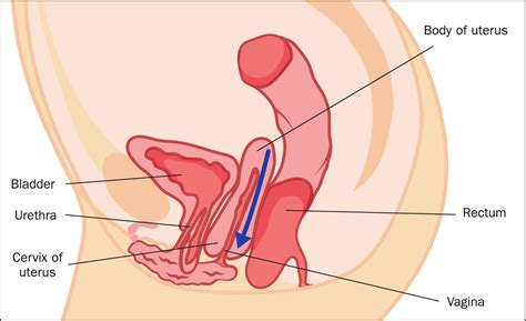 Prolapsed Uterus Stages