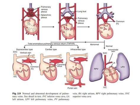 Classification And Pathophysiology Of Tapvc Pptx