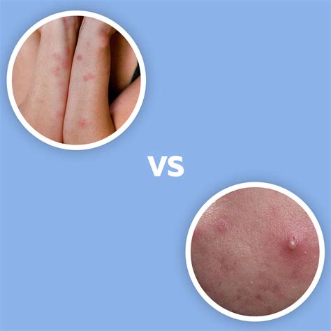 Bed Bug Bites Vs Pimples Bed Bug Sos