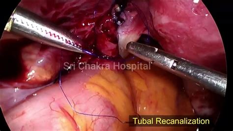 Tubal Recanalization Youtube