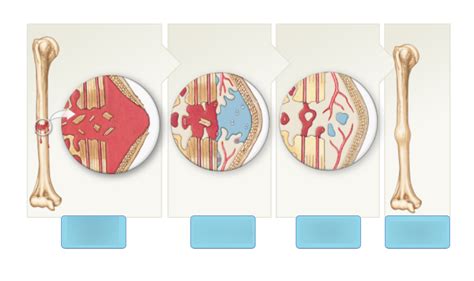 Steps To Repair Fracture Diagram Quizlet