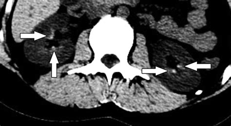Visualization Of Renal Medullary Hyperattenuation At Unenhanced Ct