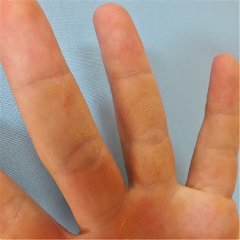 A Very Rare Localization Of A Rare Disease Palmar Lichen Nitidus
