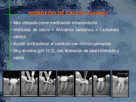 Universidad Rmulo Gallegos Medicacin Intraconducto En La Teraputica