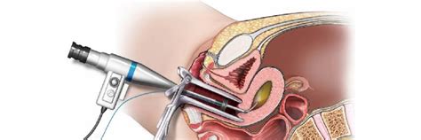 Hysteroscopy Procedure Maha Fertility Centre