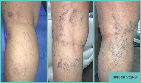 Spider Veins On Legs Feet Preventing Spider Veins Causes And