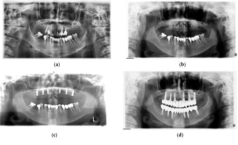 Pdf Regeneration Of Horizontal Bone Defect In Edentulous Maxilla