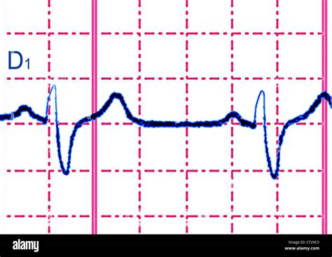 Right Bundle Branch Block