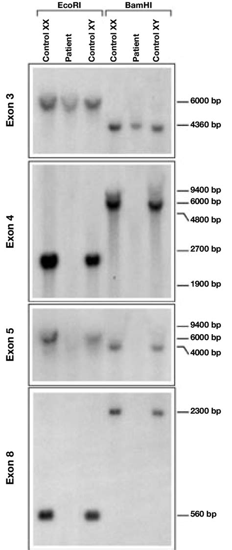 Southern Blot Analysis Of Genomic Dna From Leukocytes Of A Patient