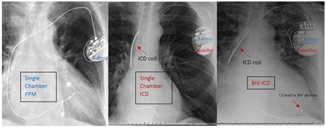 Icd Vs Pacemaker Figure 2 From Evaluation And Monitoring Of Patients With Cardiovascular