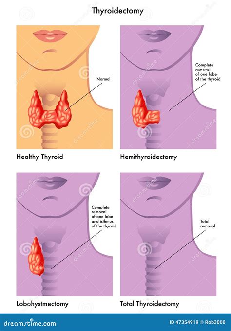 Thyroidectomy Clipart And Illustrations