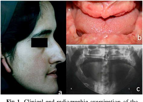 Figure 1 From New Method For Fabrication Of Gunning Splint In