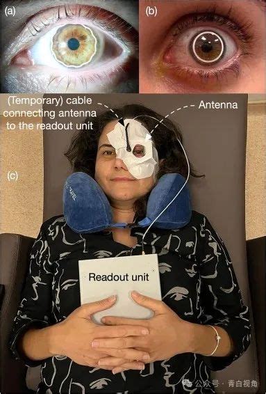 新型电无源传感器技术诊断监测青光眼 好医术文章 好医术 赋能医生守护生命