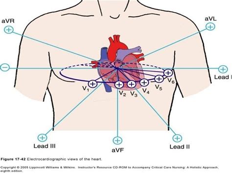 12 Lead Ecg Placement Cardiac Nursing Critical Care Nursing Artofit