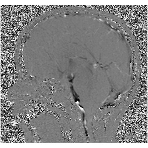 Postoperative Mri 2d Phase Contrast With Third Ventricle Csf Flow