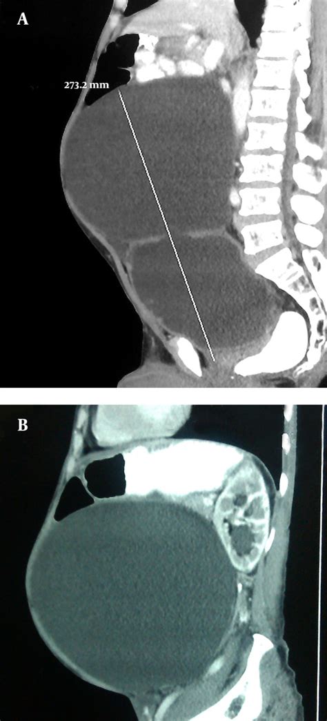 Bladder Diverticulum Cystoscopy