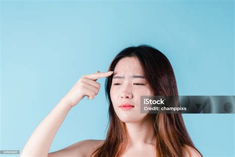 Asian Woman Having Skin Problems Acne Spot Her Squeezing Pimples On Her Face On The Blue ...