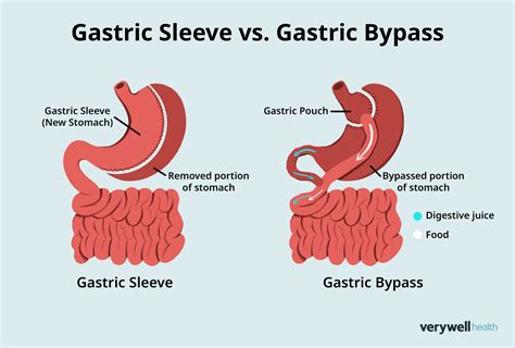 Gastric Sleeve Vs Gastric Bypass Pros And Cons