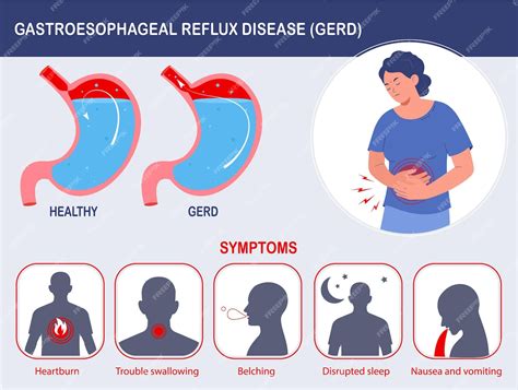 Premium Vector Gastroesophageal Reflux Disease Gerd Infographic Gerd Symptoms Medical Info