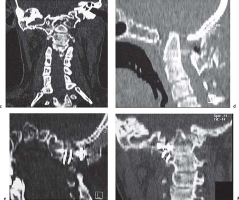31 Rotatory Atlantoaxial Dislocation Neupsy Key
