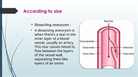 Aneurysm Classification Of Aneurysm And Causes Of Aortic Aneurysm Pptx