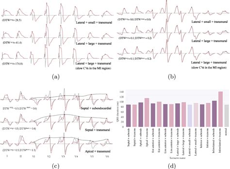 Figure 1 From Influence Of Myocardial Infarction On Qrs Properties A
