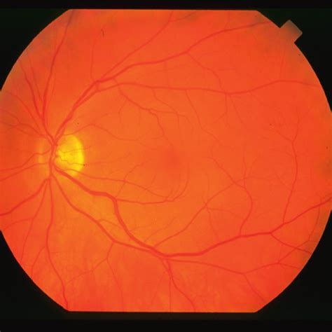 Image Of A Normal State Retinal Vessel Network File Im0162 Tif The Download Scientific