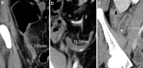 Example Of The Appendix Diameter On Contrast Enhanced Abdominal Ct
