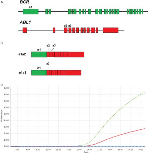 Philadelphia Chromosome Positive Acute Myeloid Leukemia With E1a3 Bcr Abl1 Fusion Transcript Pmc