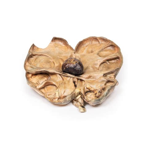 Hydronephrosis And Hydroureter Caused By Obstruction By A Renal