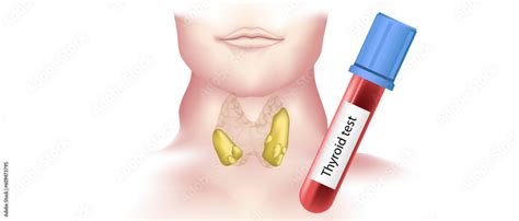 เวกเตอร์ Stock Hypothyroidism Vs Hyperthyroidism Healthy And Unhealthy