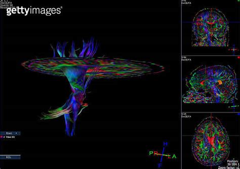 Tractography Dti Diffusion Tensor Imaging Mri Of The Brain 이미지 177844800 게티이미지뱅크