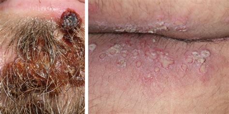 Transmission Of Monkeypox Virus Through Sexual Contact A Novel Route Of Infection Abstract