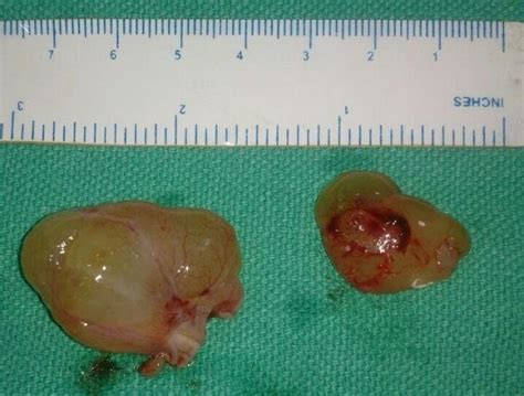 Removed Polyp Larger Pharyngeal Part And Small Nasal Part Download