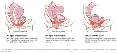 Everything You Need To Know About Prolapse Or Organ Descent Healthy