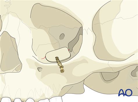 Orbital Reconstruction For Orbital Floor Fracture