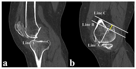 Osteophytes Knee