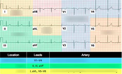Interpretation Of Leads Diagram Quizlet